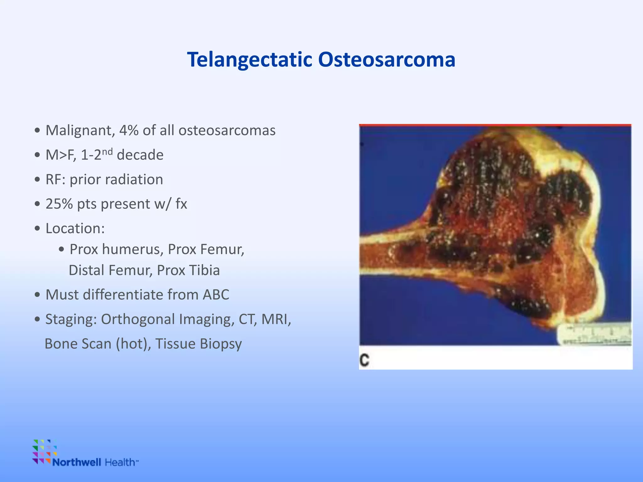 Osteosarcoma | PPTX