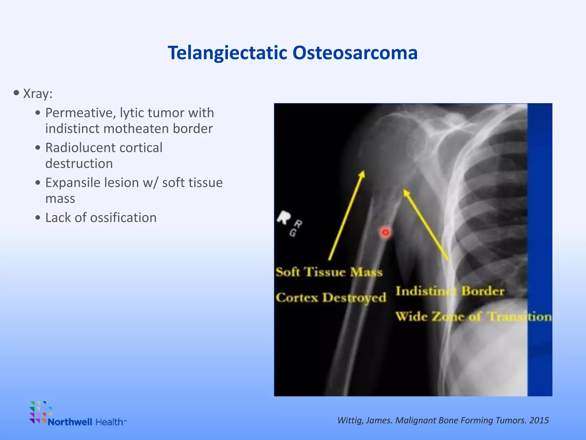 Osteosarcoma | PPTX