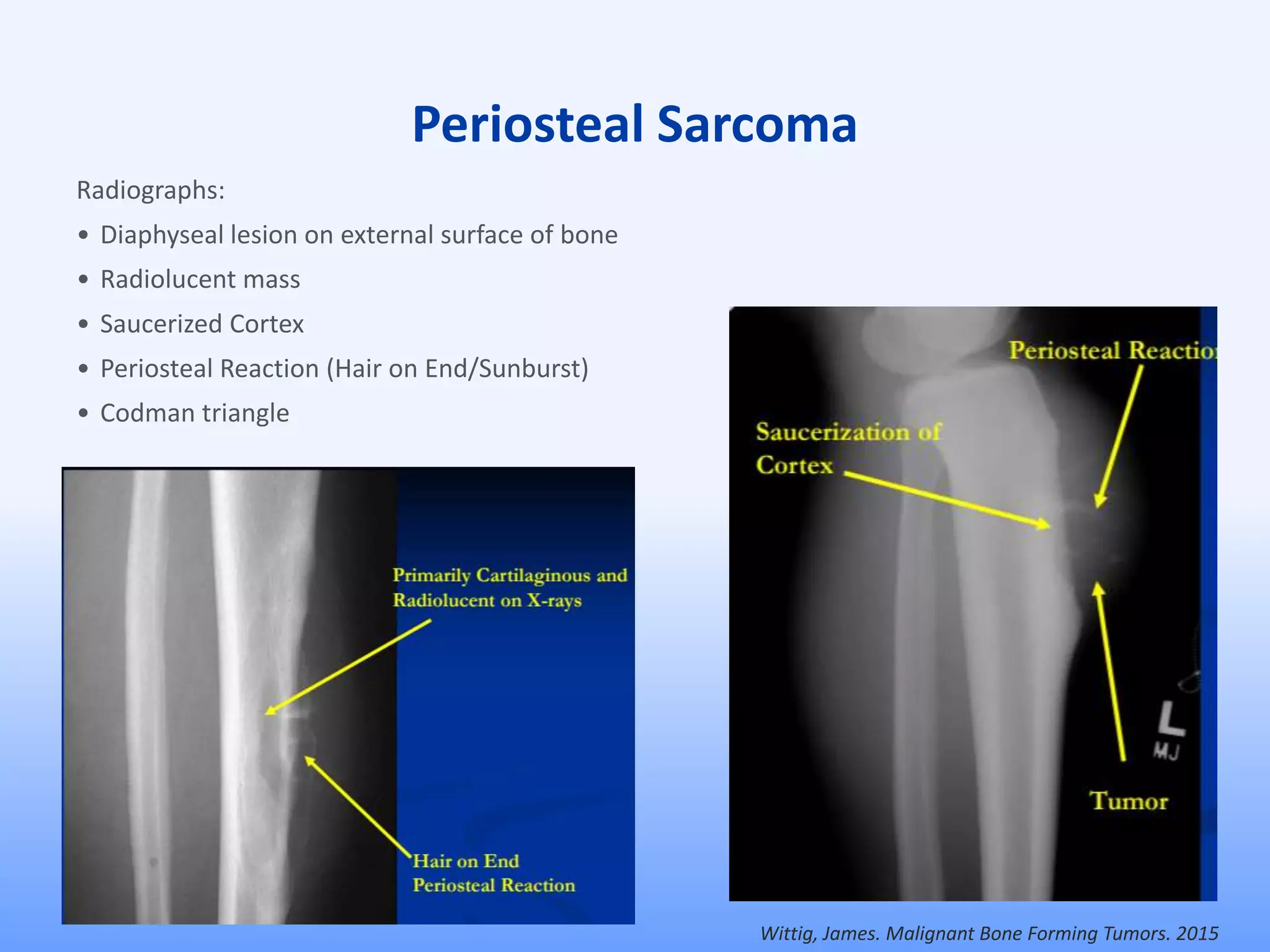 Osteosarcoma | PPTX