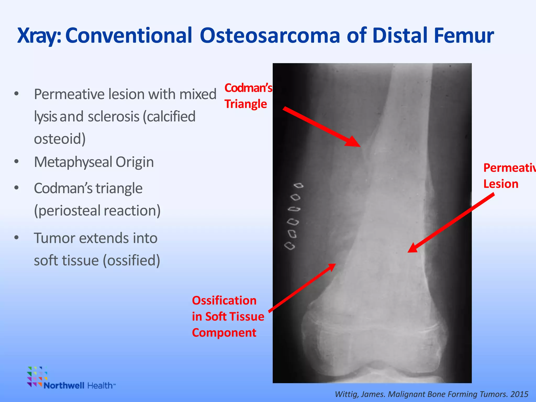 Osteosarcoma | PPTX