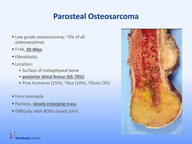 Osteosarcoma | PPTX