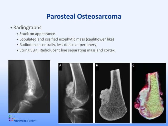 Osteosarcoma | PPTX