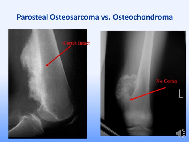 Osteosarcoma | PPTX
