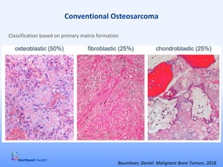 Osteosarcoma | PPTX