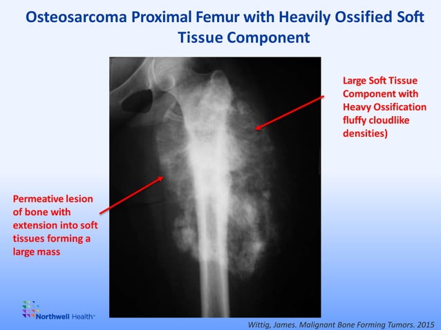 Osteosarcoma | PPTX