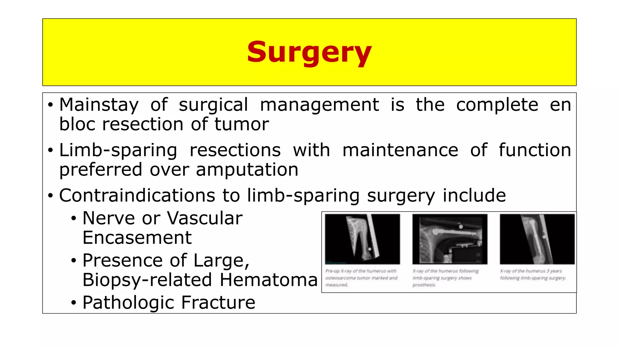 OSTEOSARCOMA | PPTX