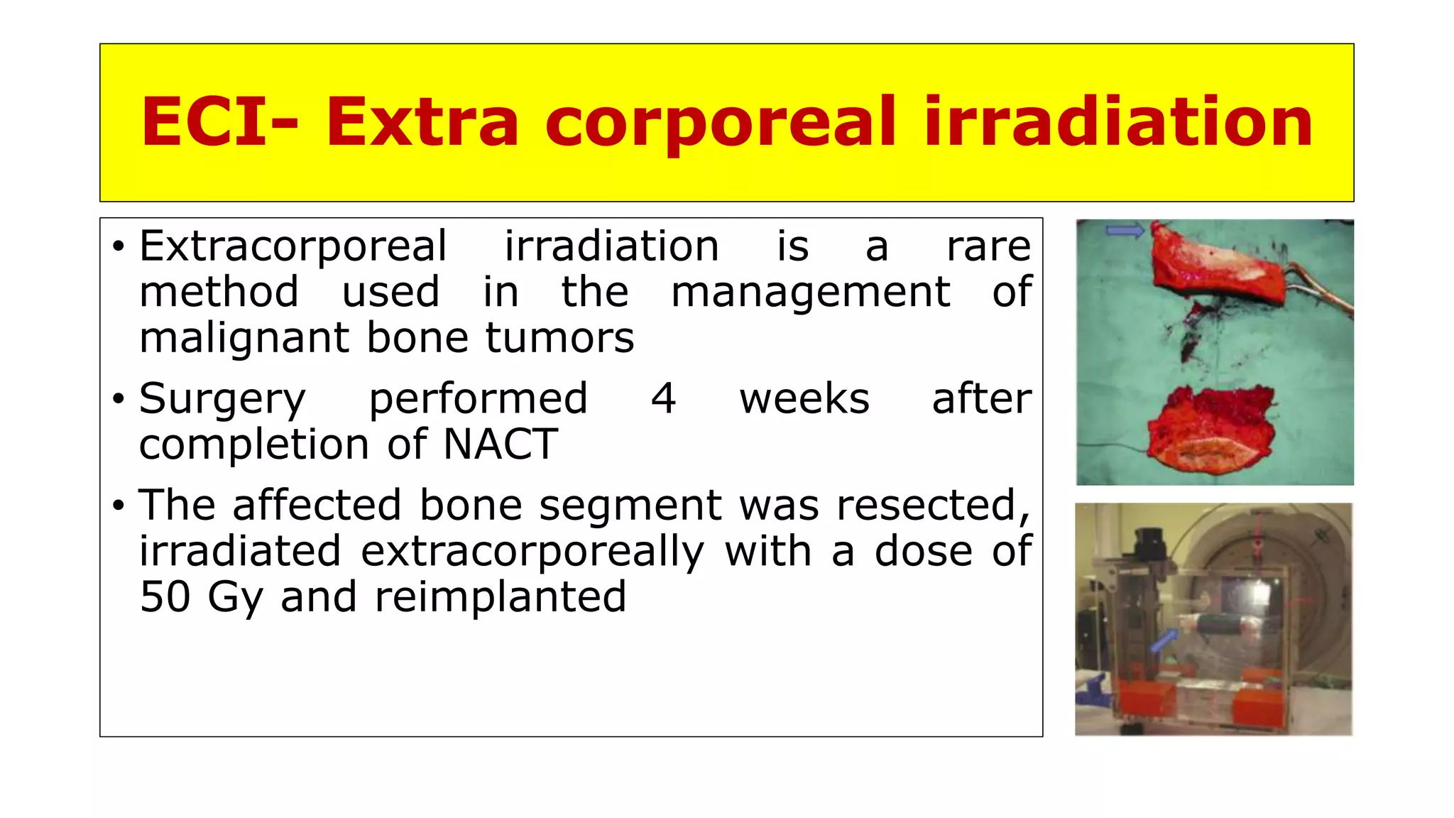 OSTEOSARCOMA | PPTX