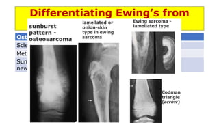 Osteosarcoma Sunburst Appearance