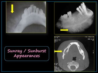 osteosarcoma.ppt