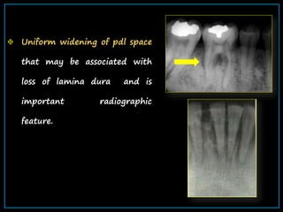 osteosarcoma.ppt