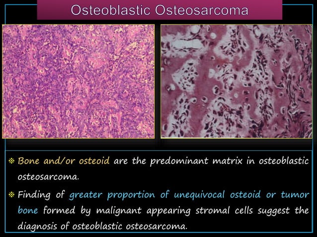 osteosarcoma.ppt | Bone and Joint Conditions | Diseases and Conditions
