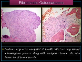 osteosarcoma.ppt