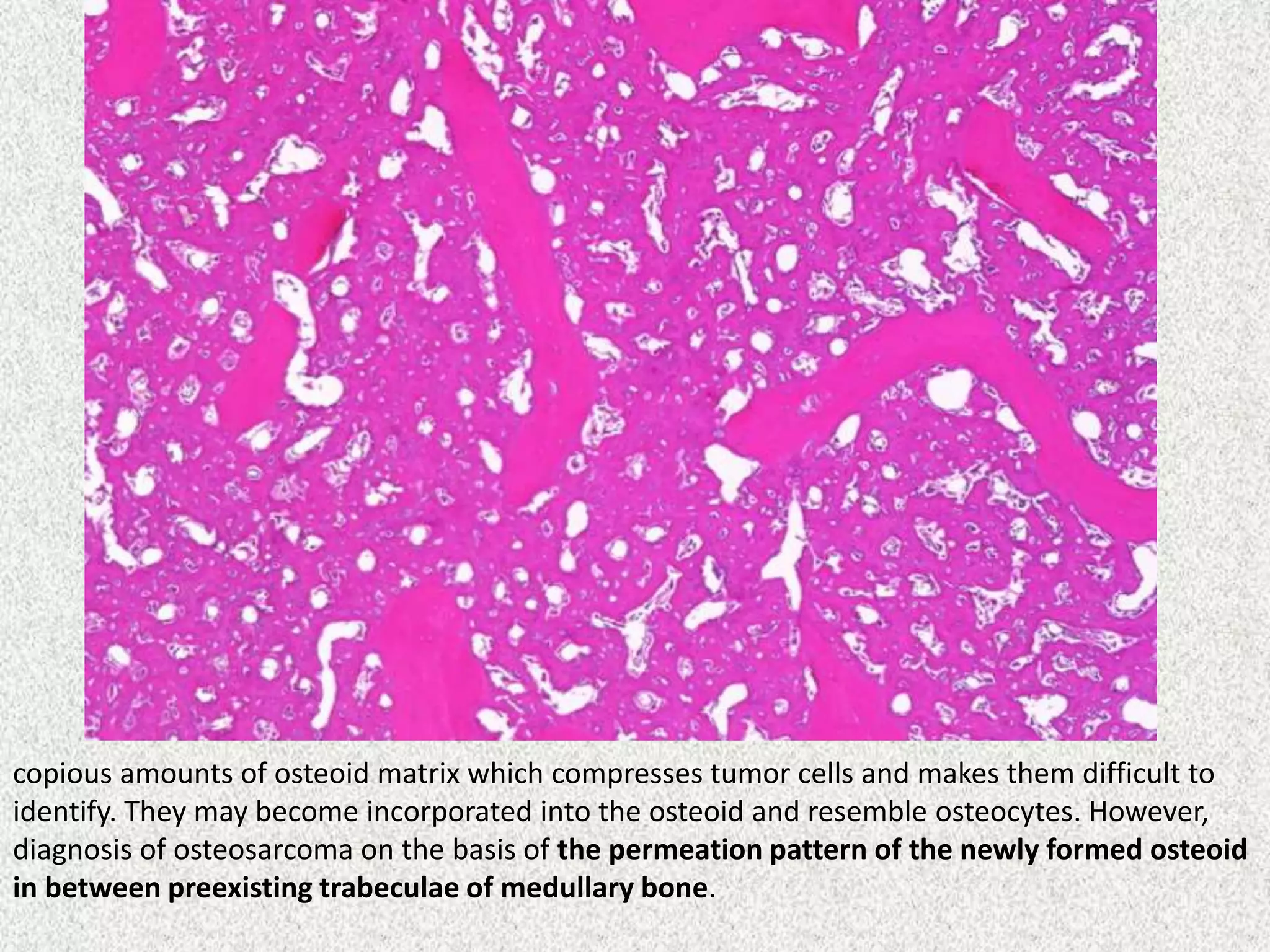 OSTEOSARCOMA.pptx