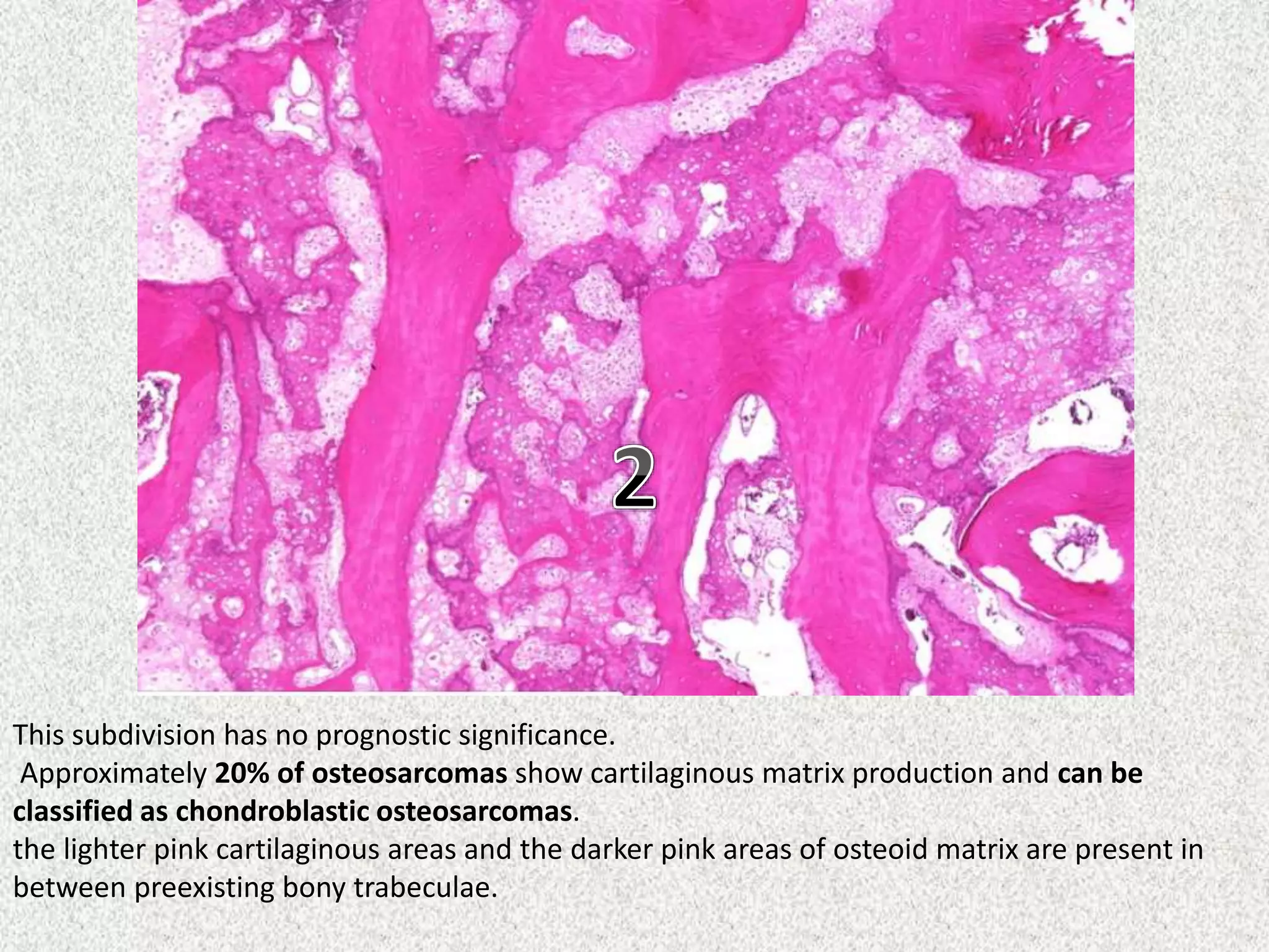 OSTEOSARCOMA.pptx