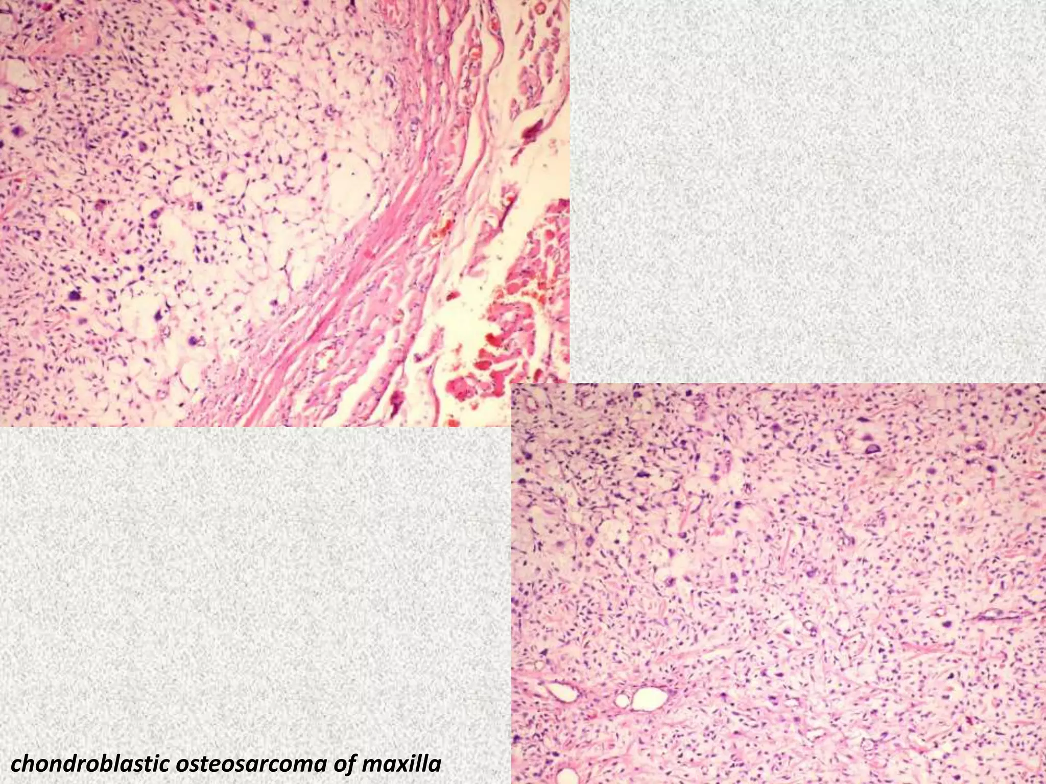 OSTEOSARCOMA.pptx