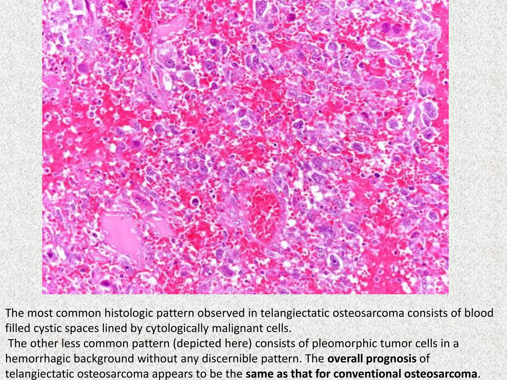 OSTEOSARCOMA.pptx