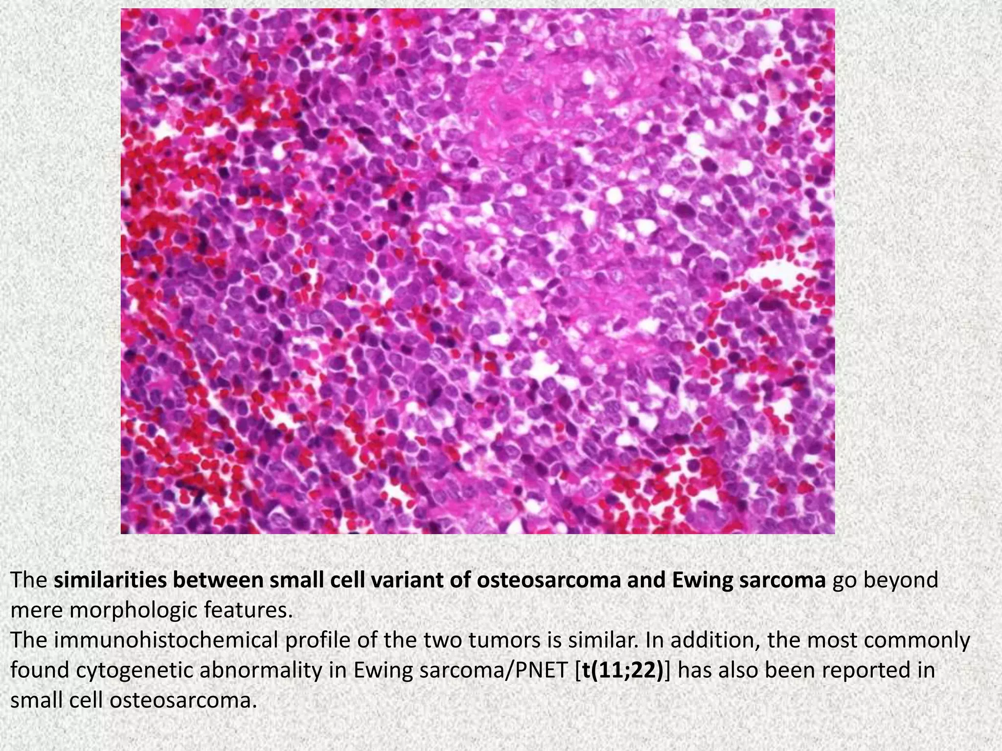 OSTEOSARCOMA.pptx