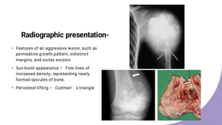 Osteosarcoma.pdf