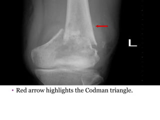 OSTEOSARCOMA- radiology description.pptx