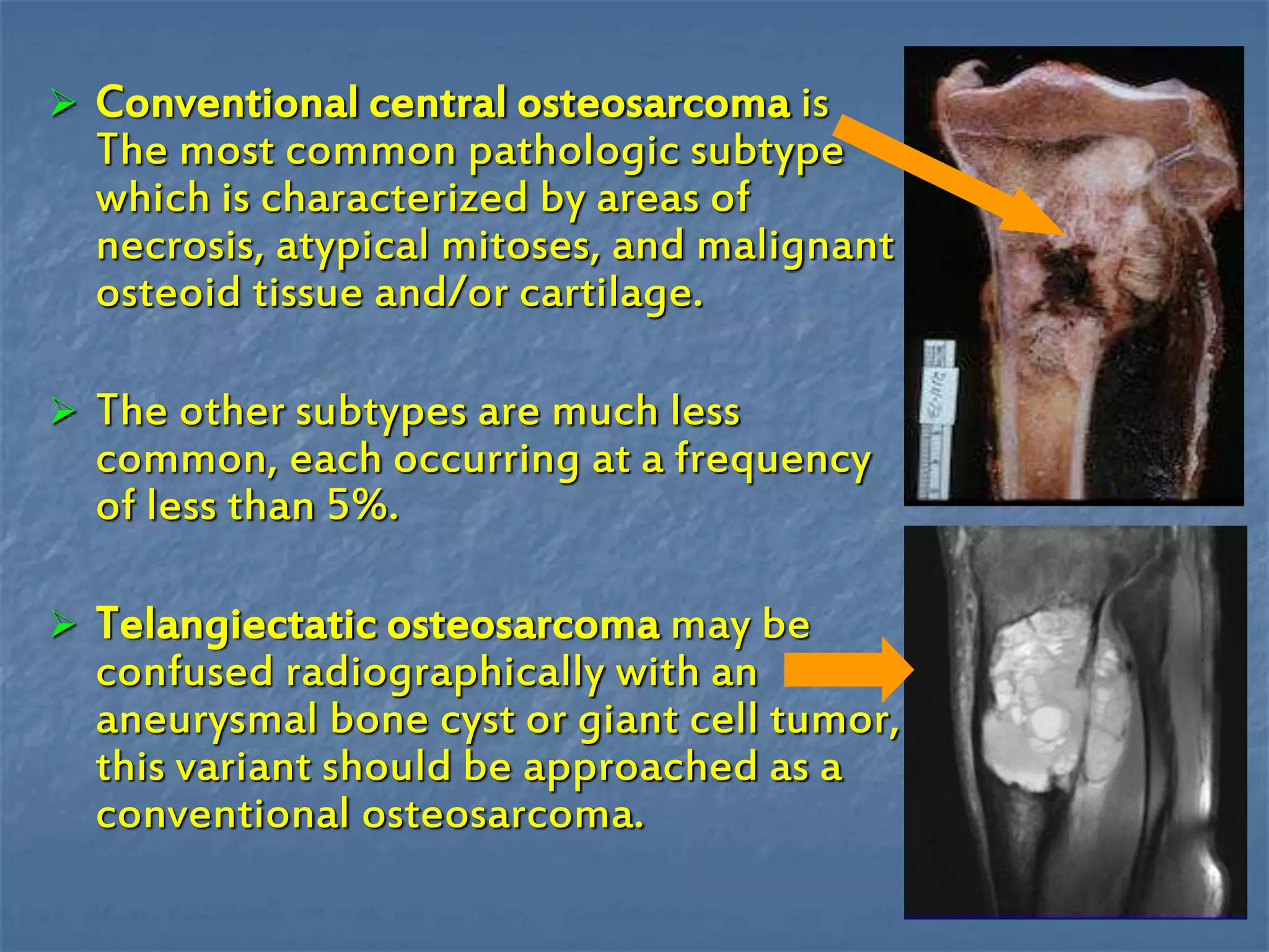 Osteosarcoma | PDF