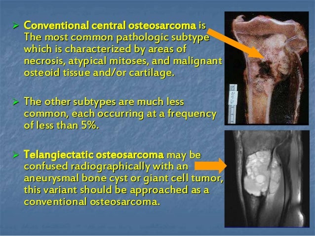 Osteosarcoma Symptoms