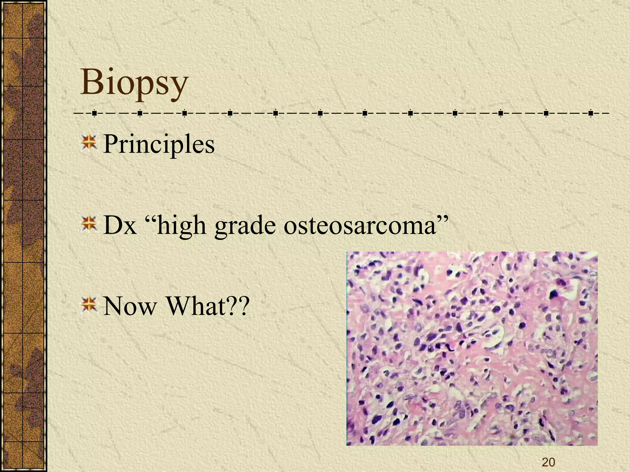 Osteosarcoma | PPT