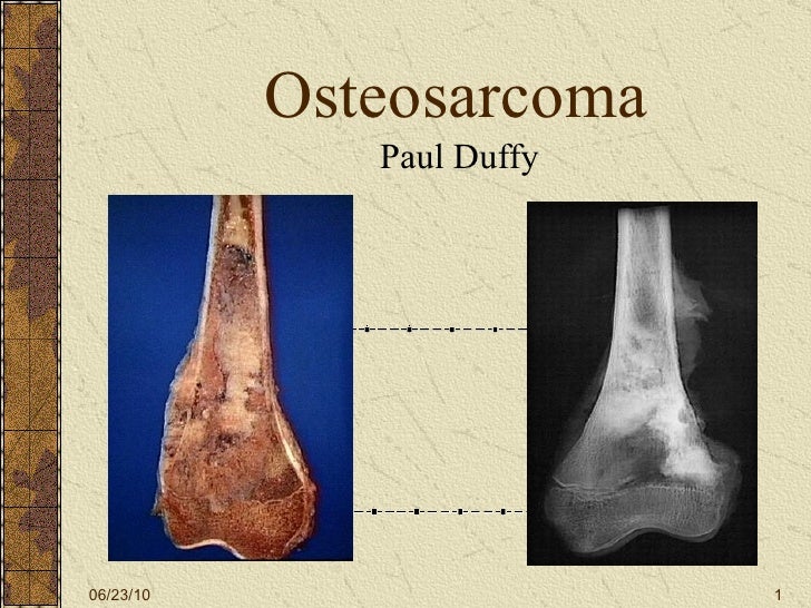 Osteosarcoma