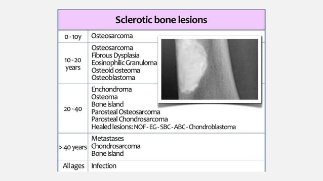Osteosarcoma & Ewings | PPTX | Bone and Joint Conditions | Diseases and Conditions