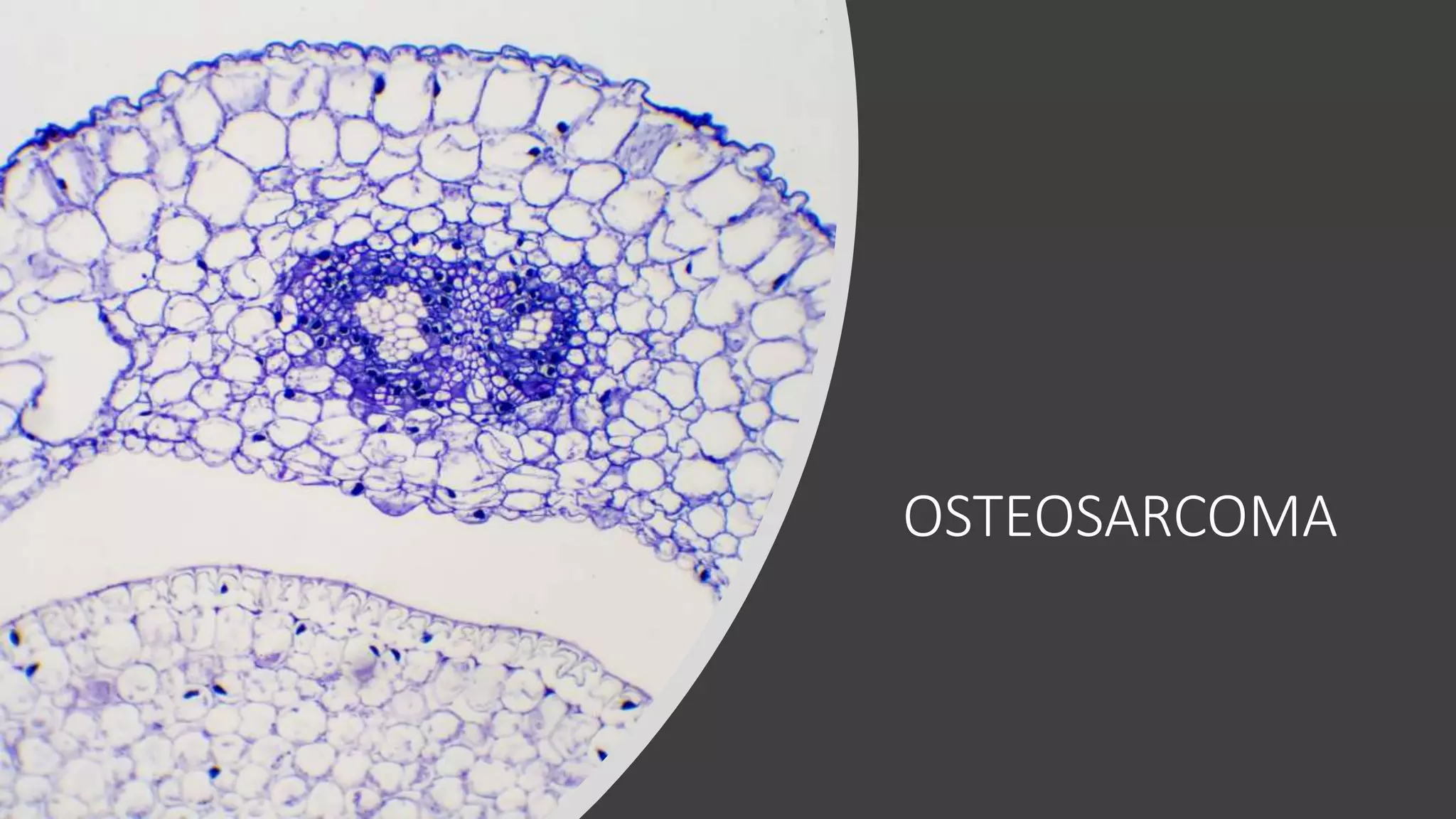 Osteosarcoma & Ewing Sarcoma.pptx