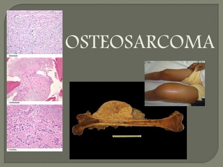 Osteosarcoma