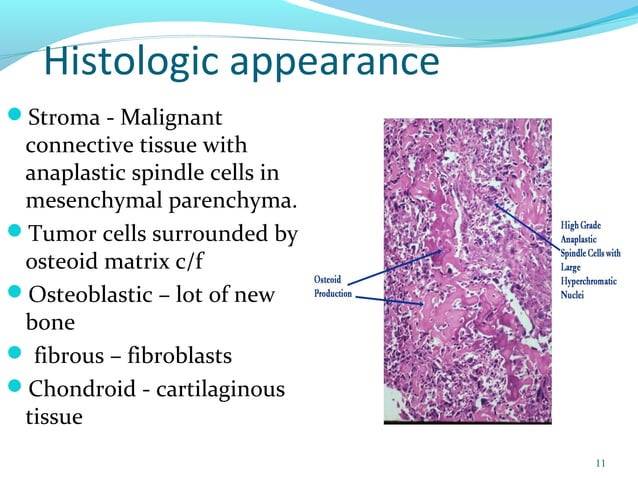 Osteosarcoma ppt | PPT | Cancer | Diseases and Conditions