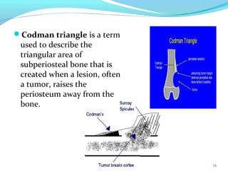Codmans Triangle