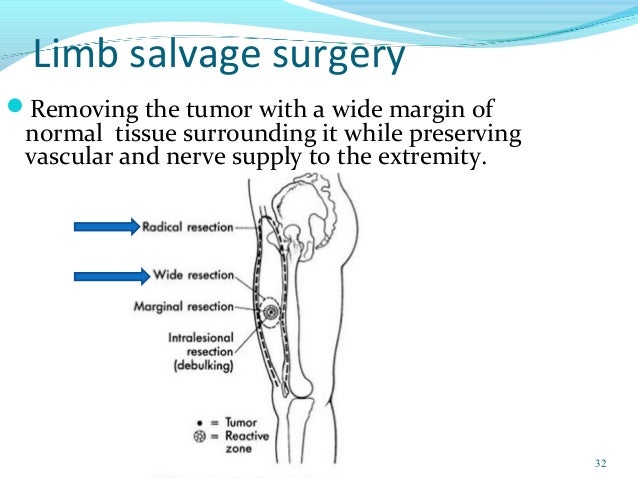 Osteosarcoma ppt