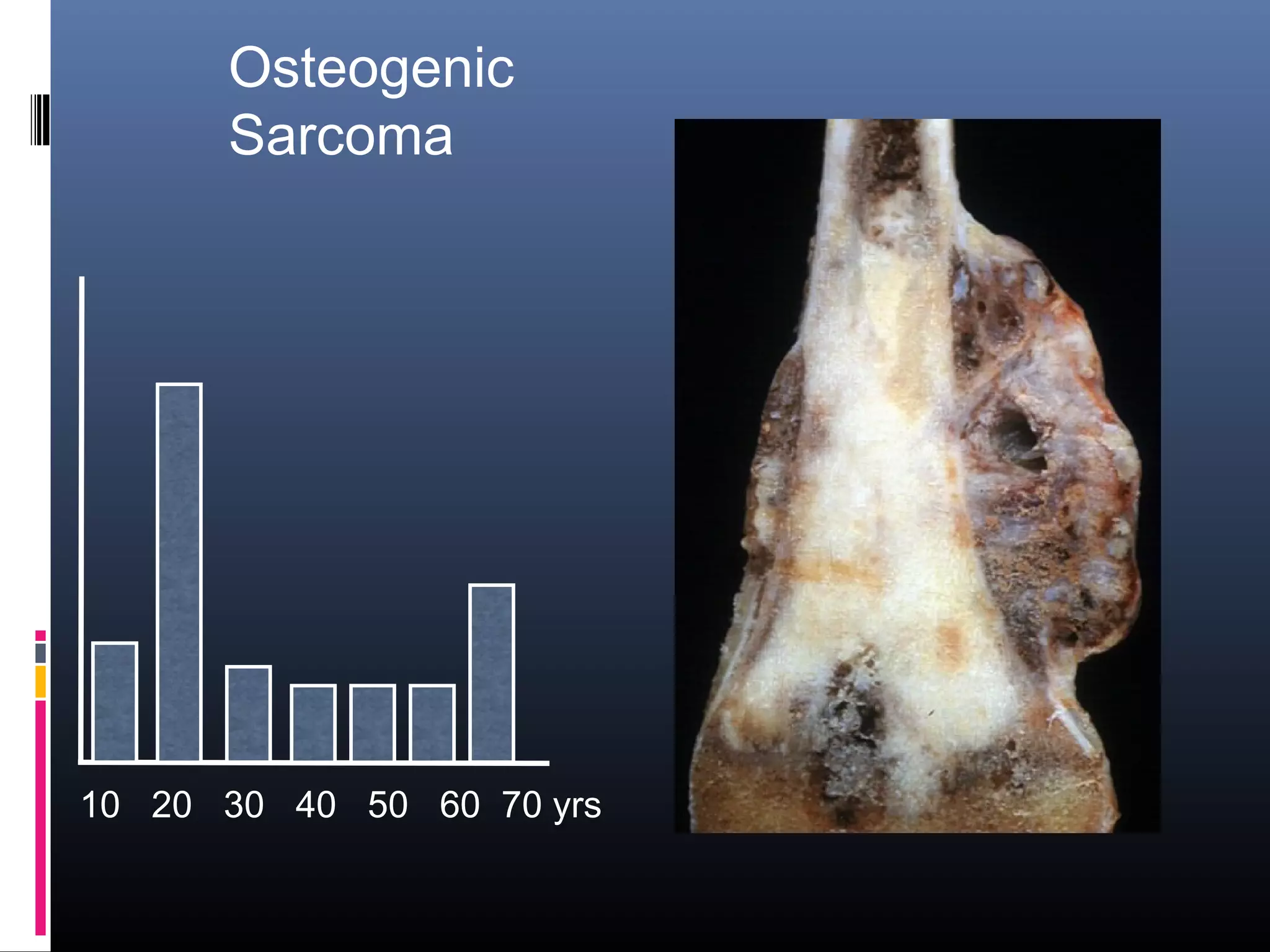 Osteosarcoma ppt | PPT