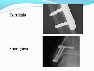 Osteosintēzes pamatprincipi | PPT