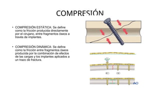 OSTEOSÍNTESIS BIOMECÁNICOS t- copia.pptx
