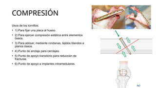 OSTEOSÍNTESIS BIOMECÁNICOS t- copia.pptx
