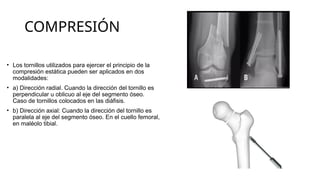 OSTEOSÍNTESIS BIOMECÁNICOS t- copia.pptx