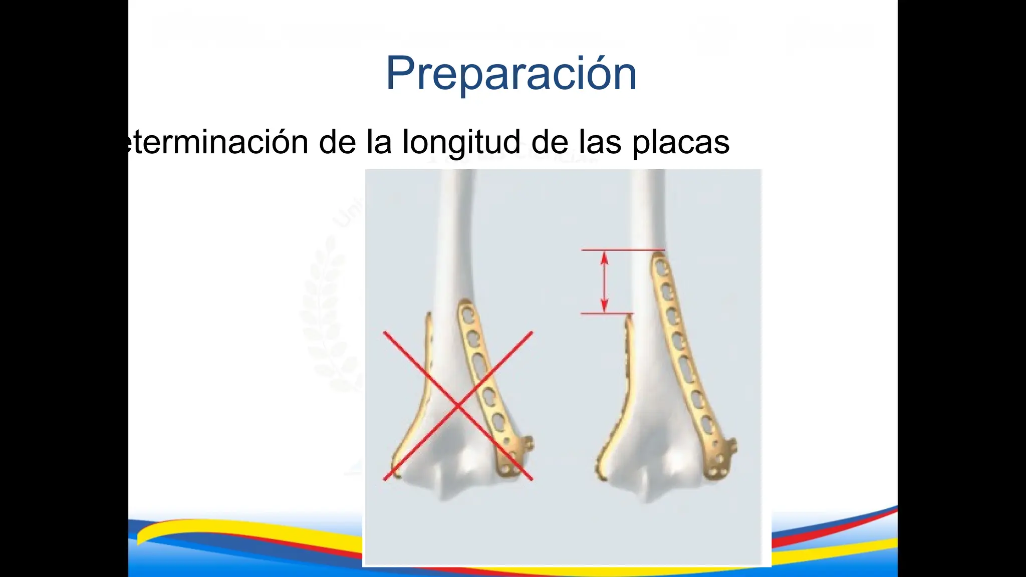 Osteosíntesis de fractura de humero distal.pptx