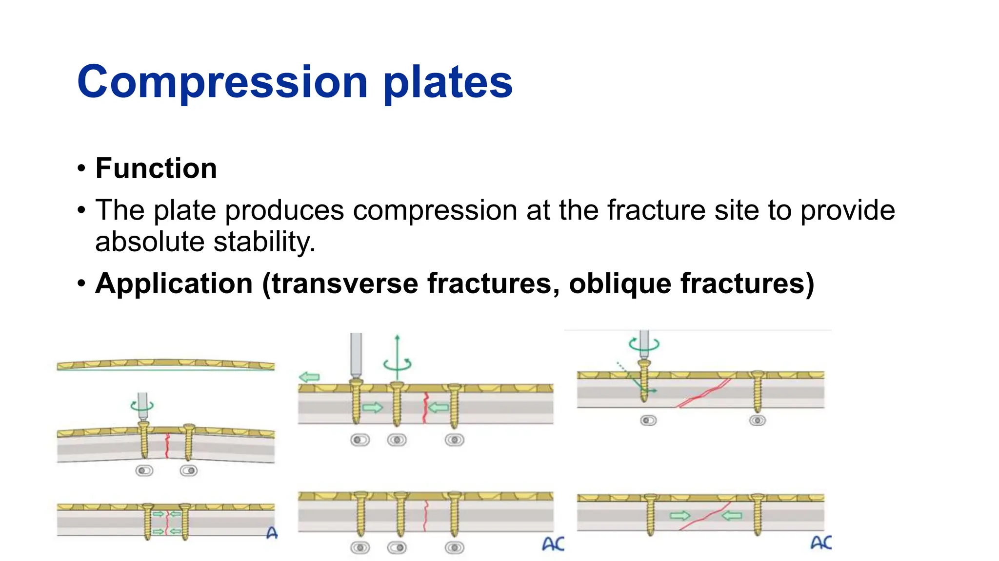 osteosynthesis.pptx