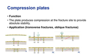 osteosynthesis.pptx