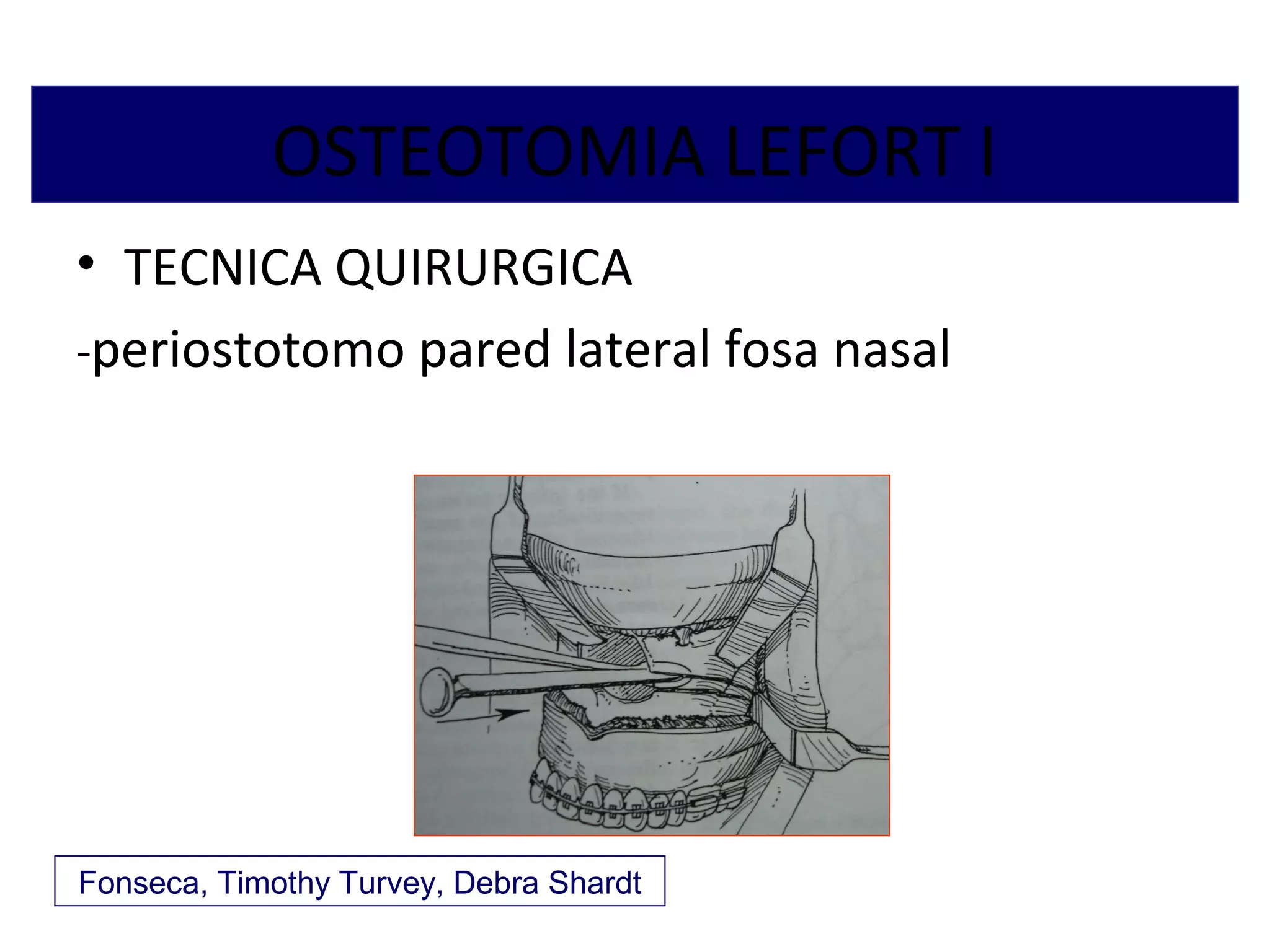 Osteotomia lefort i | PPT | Bone and Joint Conditions | Diseases and ...