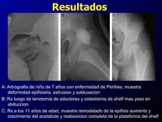 Osteotomia shelf resumido | PPT