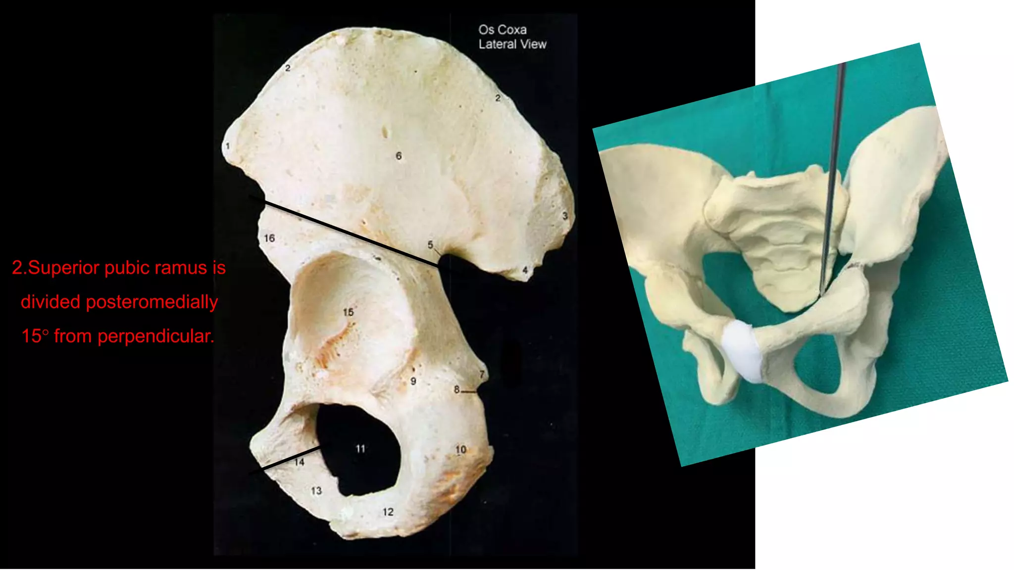 Osteotomies around hip in DDH | PPTX