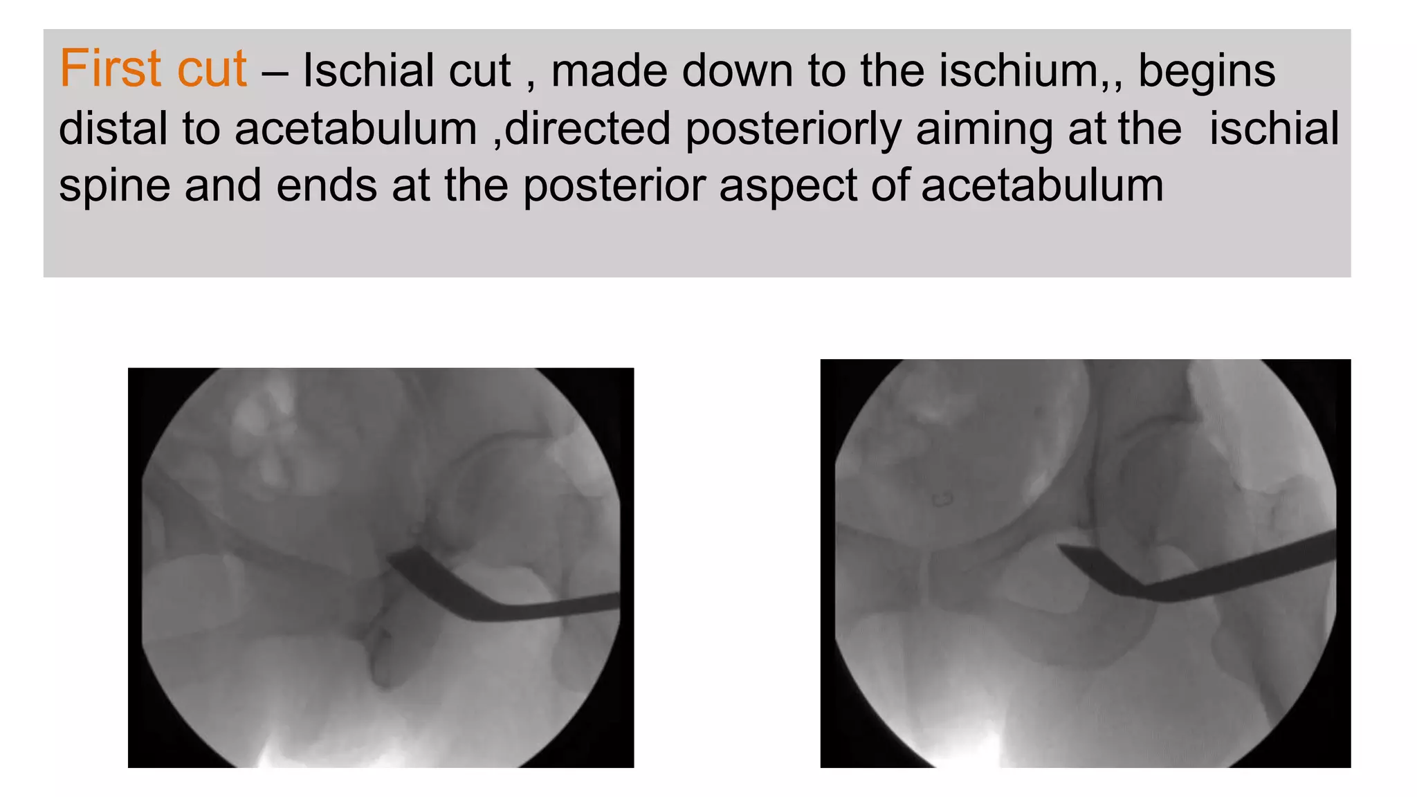 Osteotomies around hip in DDH | PPTX