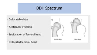 Osteotomies around hip in DDH | PPTX