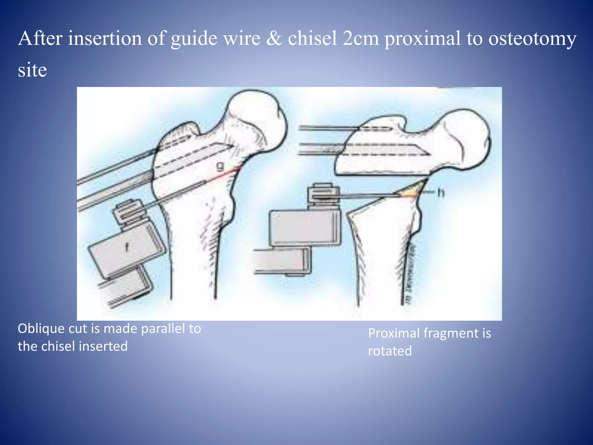 Osteotomies around the hip | PPTX