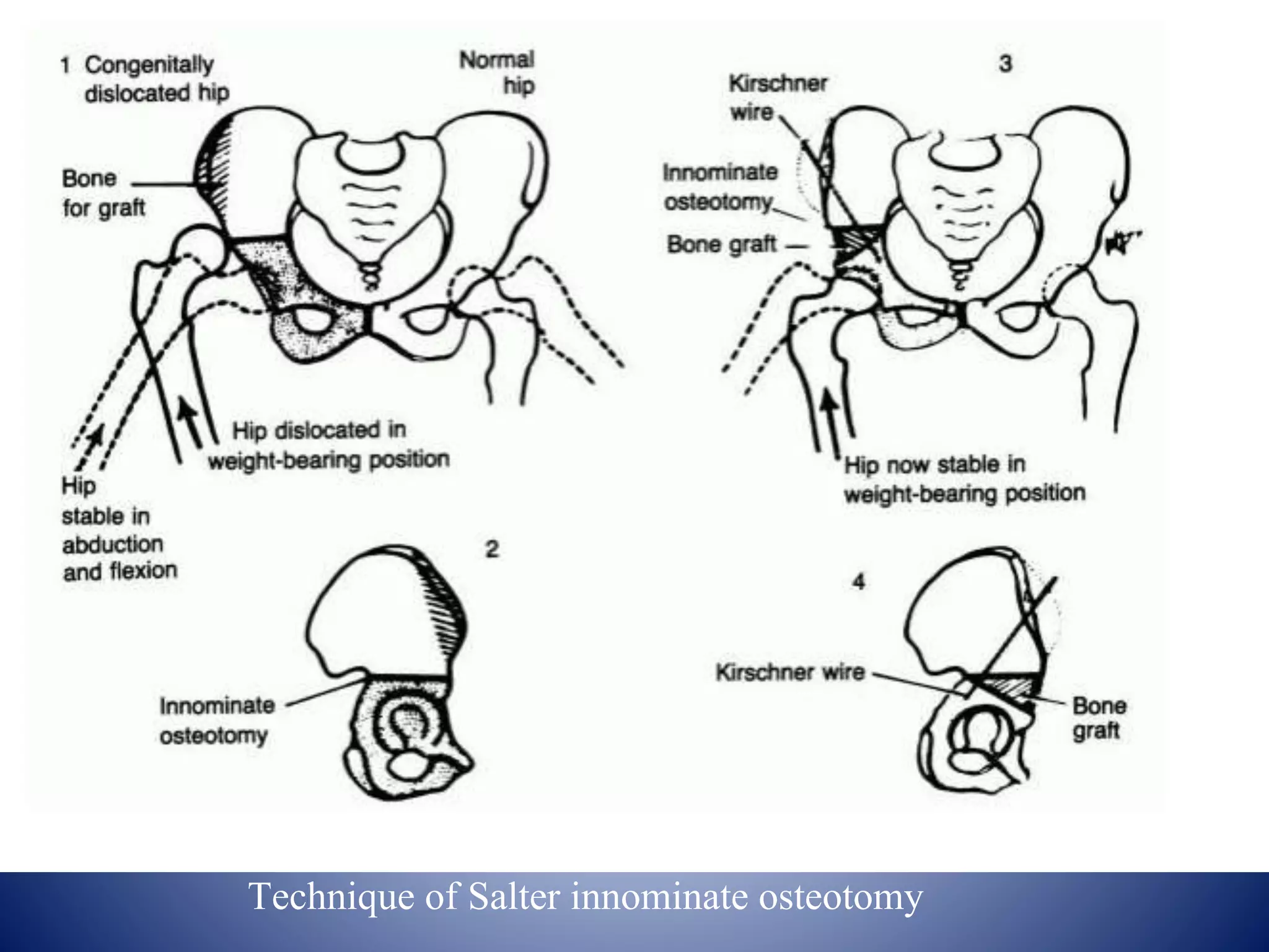 Osteotomies around the hip | PPTX