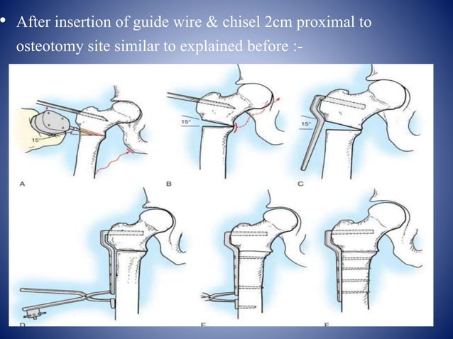 Osteotomies around the hip | PPTX | Death, Injury, or Military Conflict ...