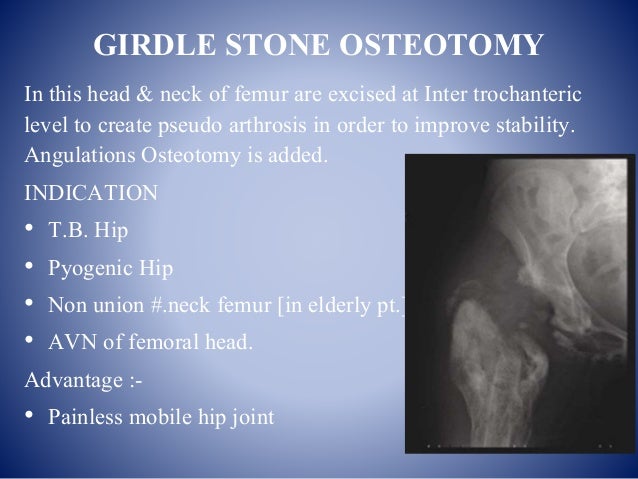 Osteotomies around the hip